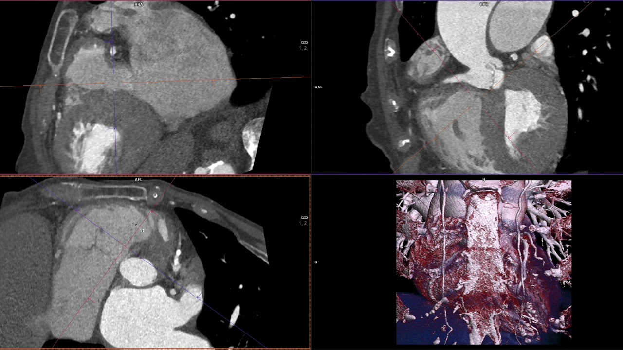 Measurement of membranous interventricular septum length in cardiac CT ...