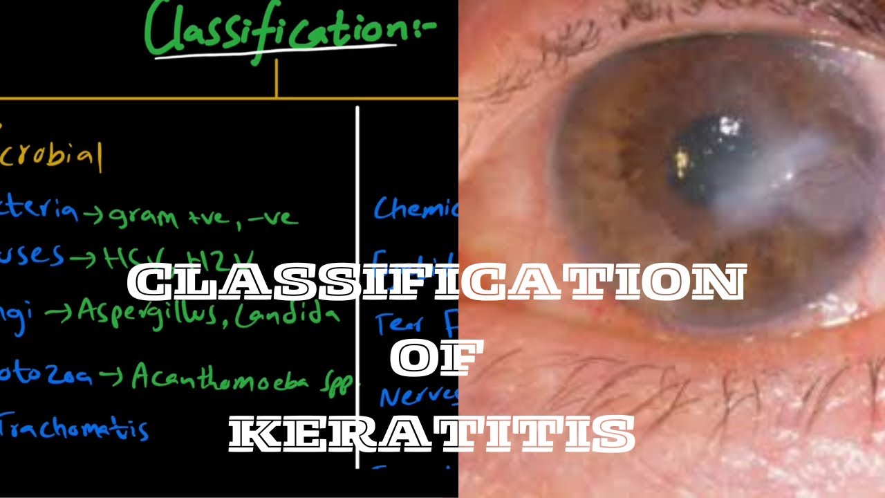 Classification of KERATITIS on fingertips with mnemonics - YouTube