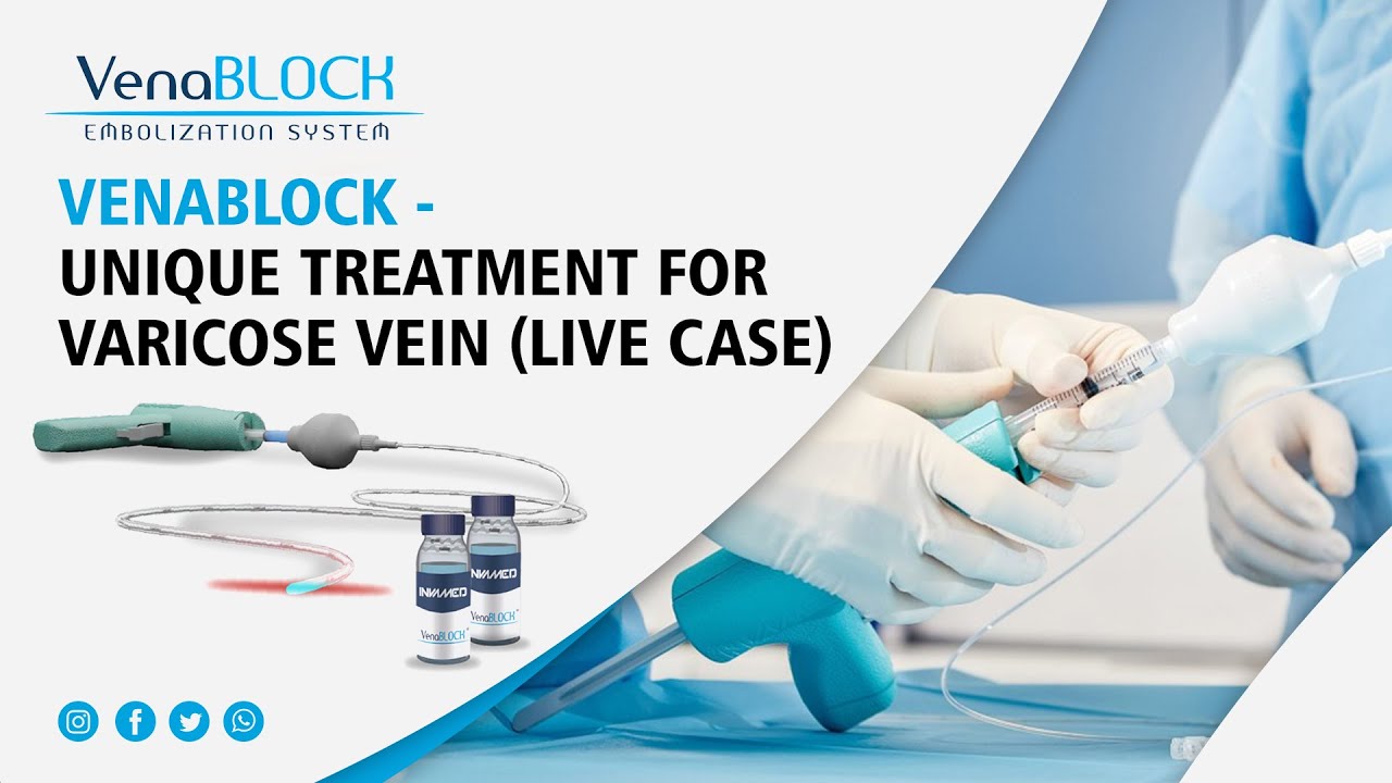 VenaBLOCK®️ Treatment for Varicose vein Live Case - YouTube