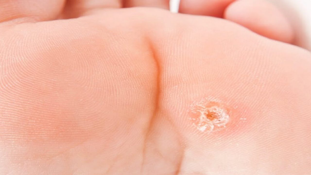 how to get rid of calluses on your feet at home permanently - YouTube