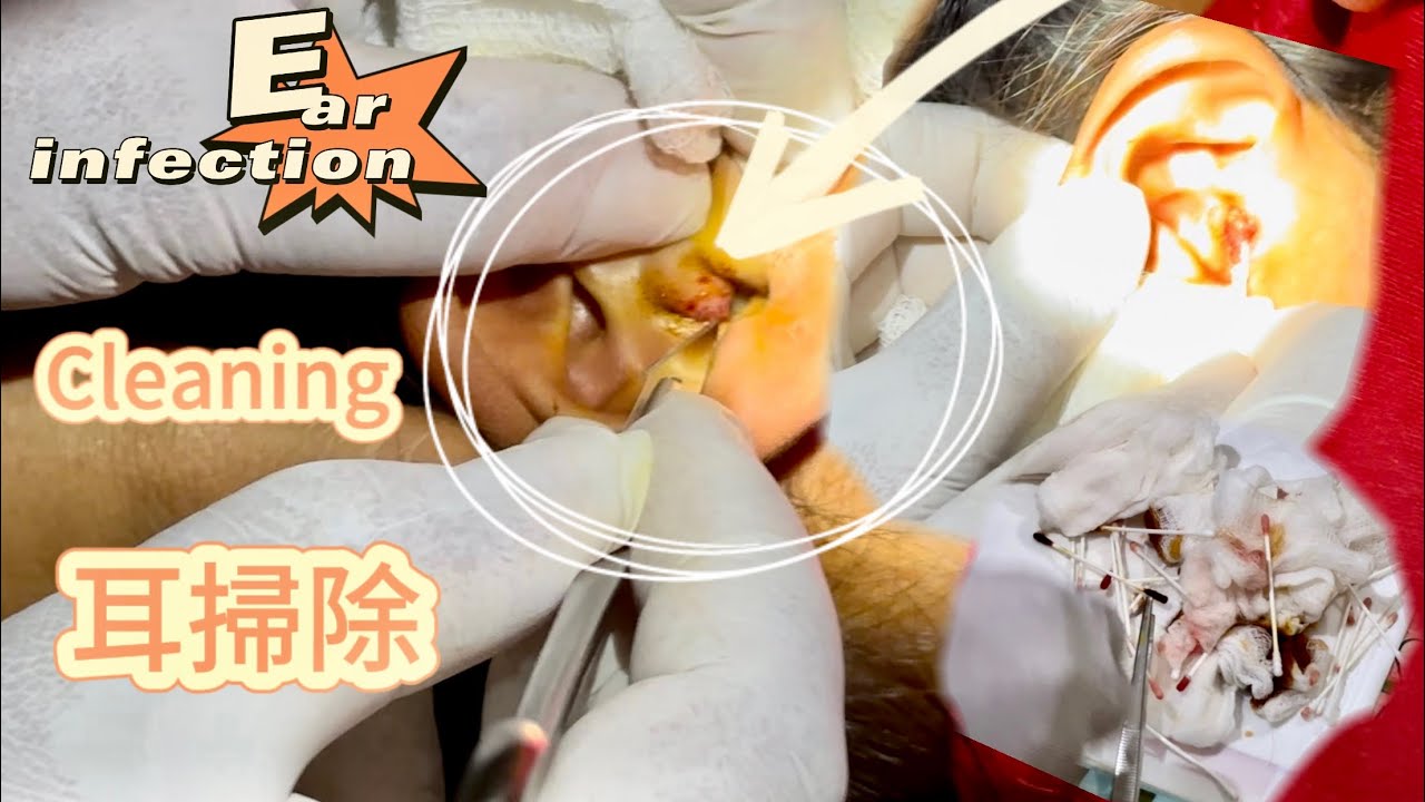 Girls' Ear Infections and Cleaning - YouTube