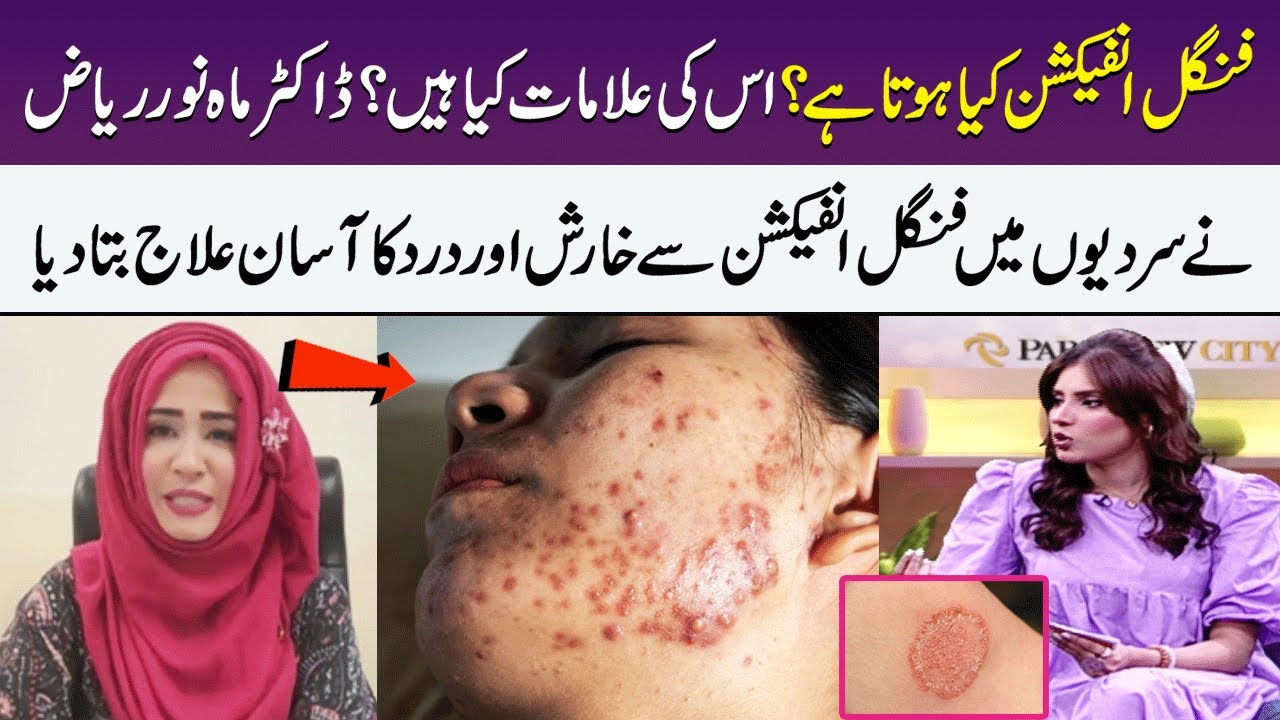 Fungal Infection Of Skin | Symptoms, Causes & Treatment | Dr. Mahnoor ...