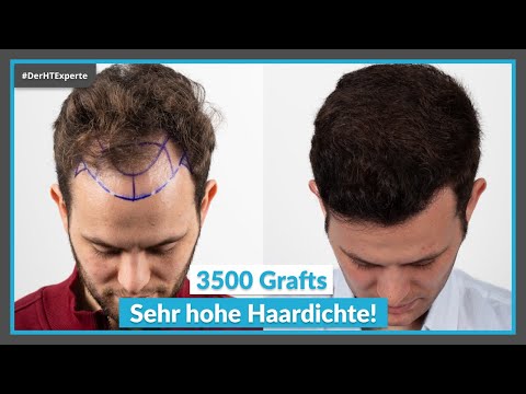 Haartransplantation Ergebnis mit SEHR hoher Haardichte | 8 Monate VORHER NACHHER [Dr. HAKAN Clinic]