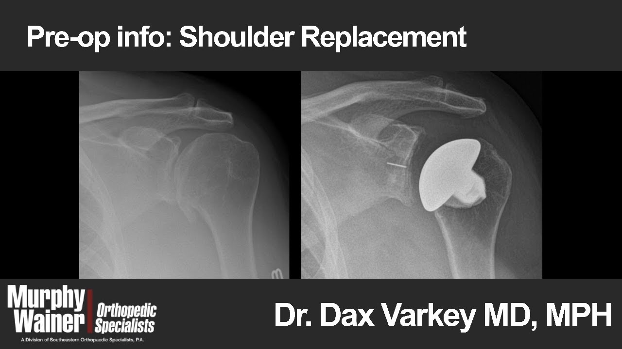 Pre-op info: Shoulder Replacement Surgery - YouTube