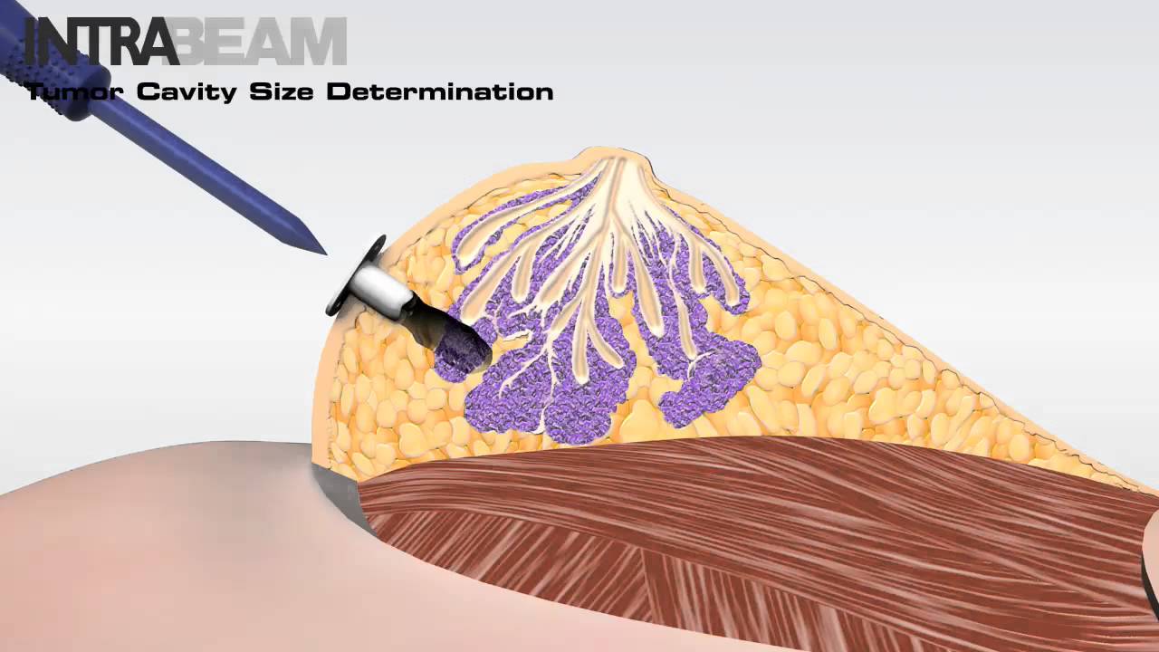 Carl Zeiss Meditec - Intrabeam Radiotherapy System Video - YouTube