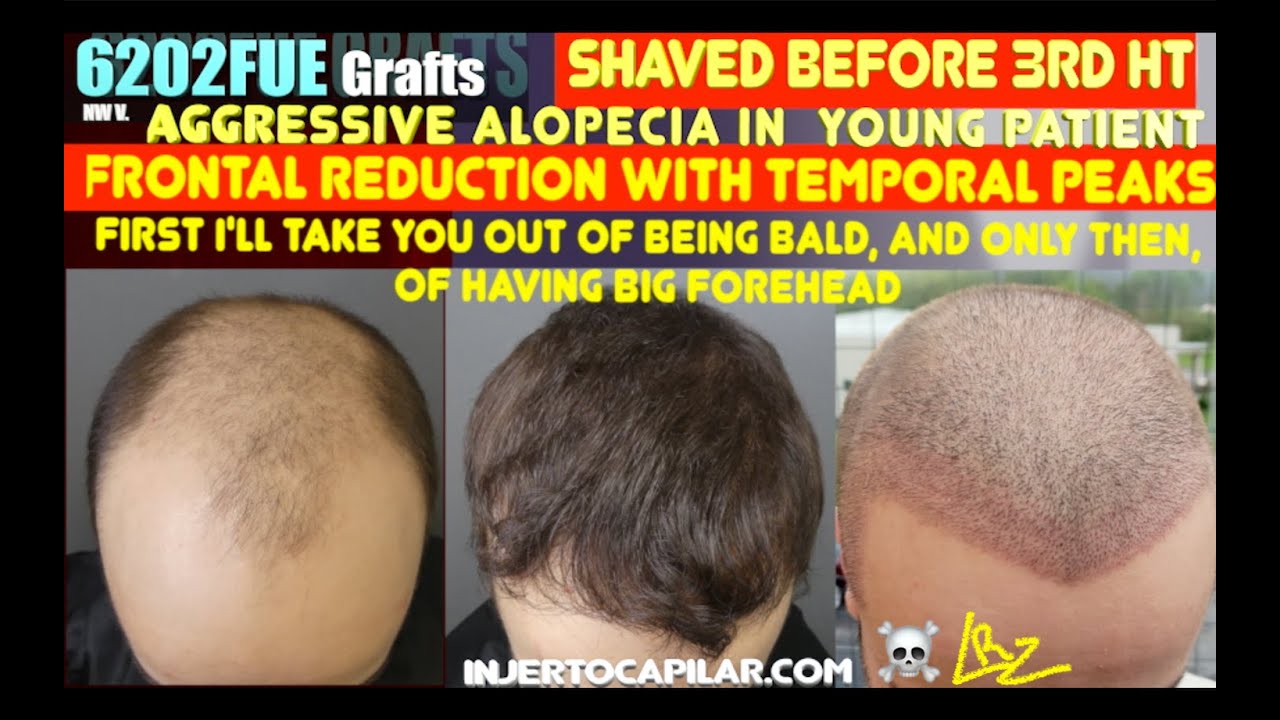 6202Grafts. Aggressive alopecia in young patient. Shaved before 3rd HT ...