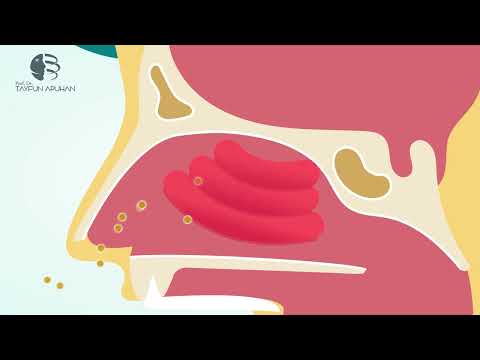 TAYFUN APUHAN -  BURUN POLİPLERİ VE TEDAVİ YÖNTEMLERİ