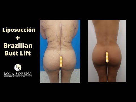 Liposuccion + Brazilian Butt Lif