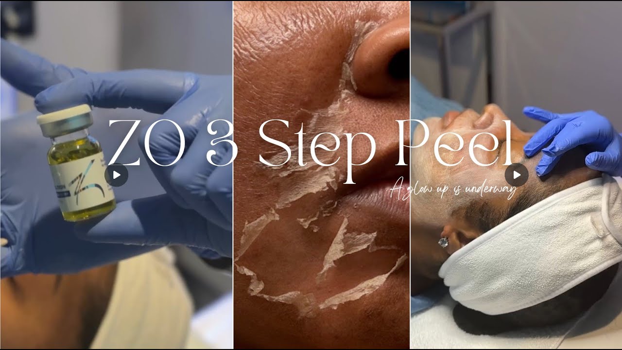 ZO 3 Step Peel | Hyperpigmentation | Texture | Acne - YouTube