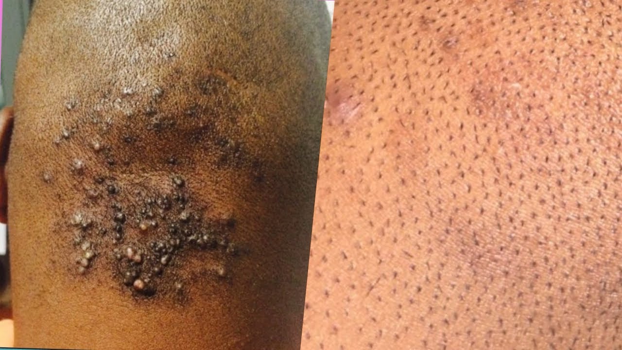 ASMR: skincare how my customer got recovery from the back pimples so ...