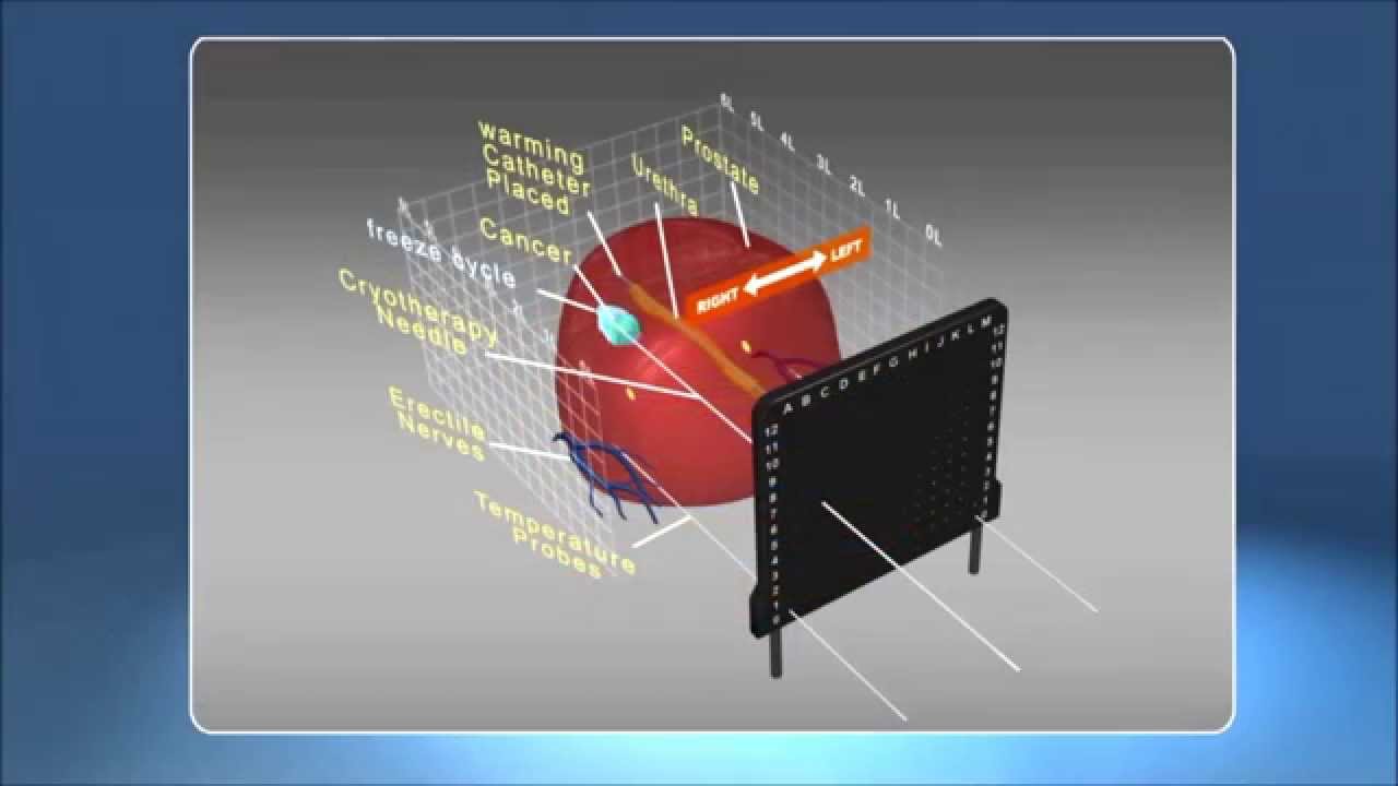 Targeted Focal Therapy of the Prostate: Treating Only the Cancer in the ...