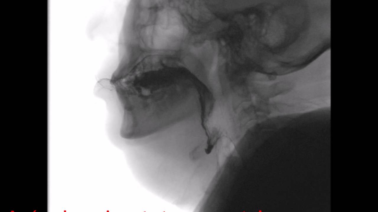 Disfagia videofluoroscopía deglución - YouTube