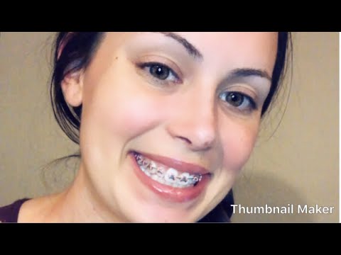 Braces (Fast-Braces) Why I got them + The Process + Cost - YouTube