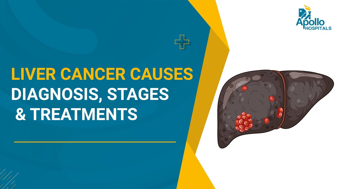 Liver Cancer - Causes, Diagnosis, Stages & Treatment | Surgical Removal ...