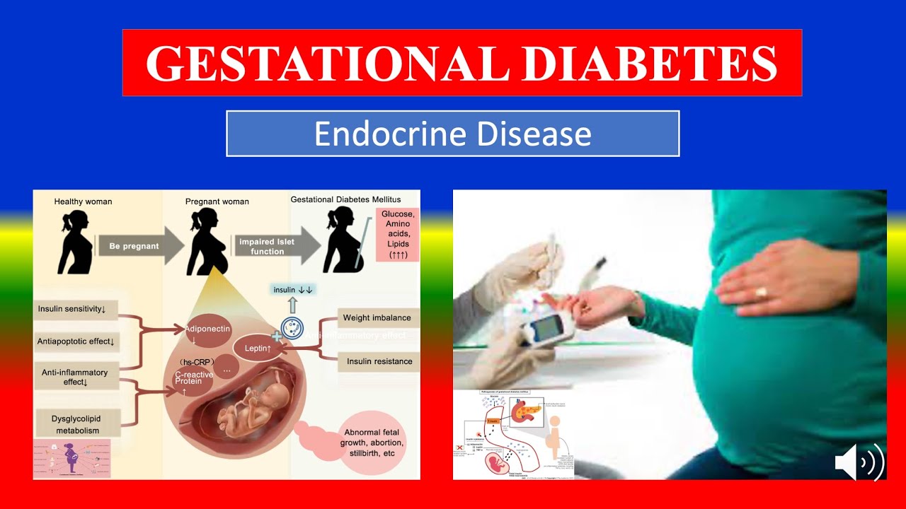 GESTATIONAL DIABETES - Definition, types, cusses, pathophysiology ...