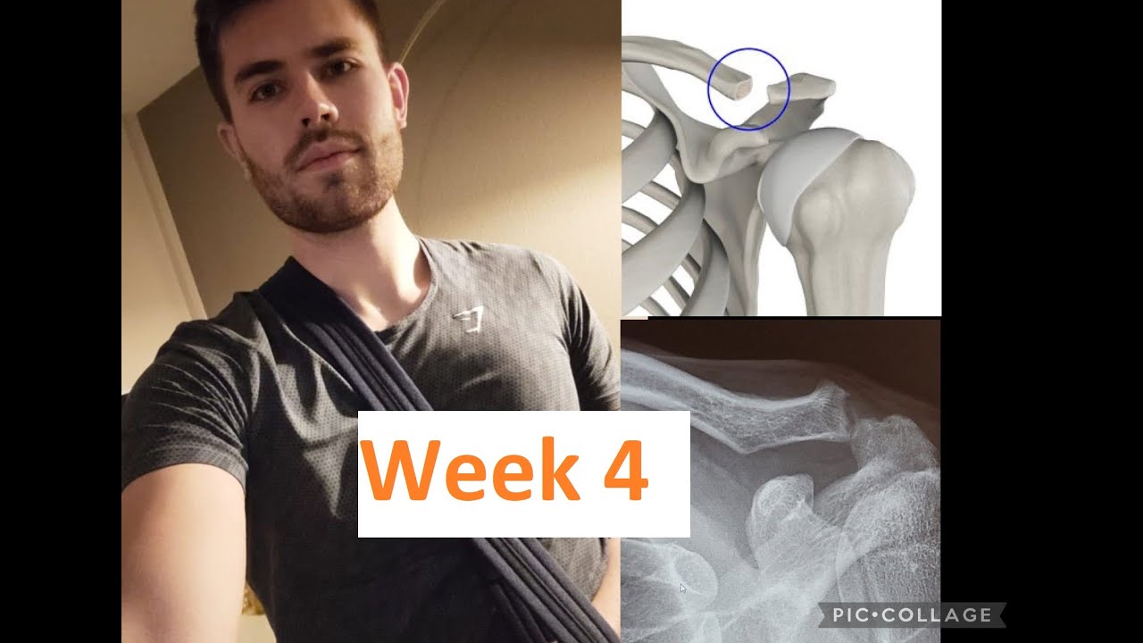 ROAD TO RECOVERY - Distal clavicle excision surgery | WEEK 4 - YouTube