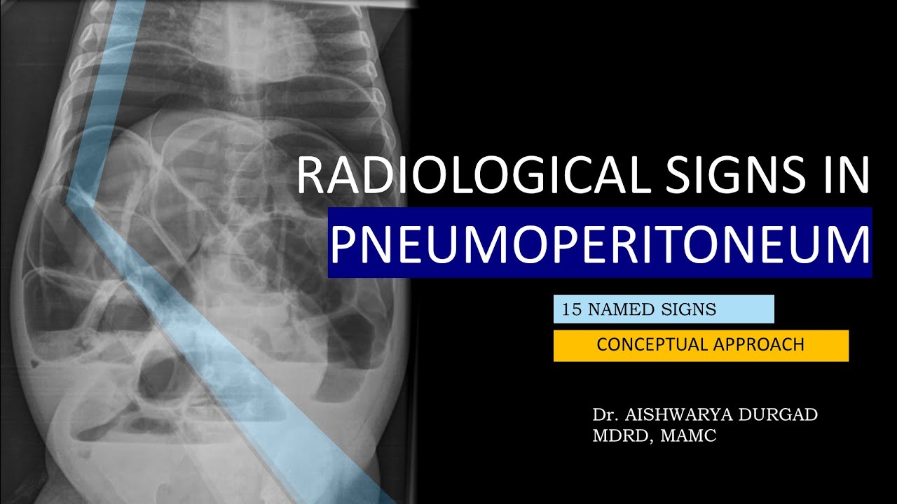 Radiological signs in PNEUMOPERITONEUM l Conceptual discussion of 15 ...
