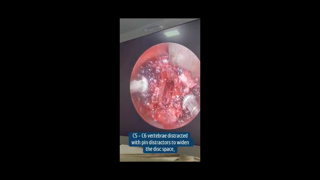 Cervical C5-C6 discectomy surgery under Endoscopic guidance for C5-C6 ...