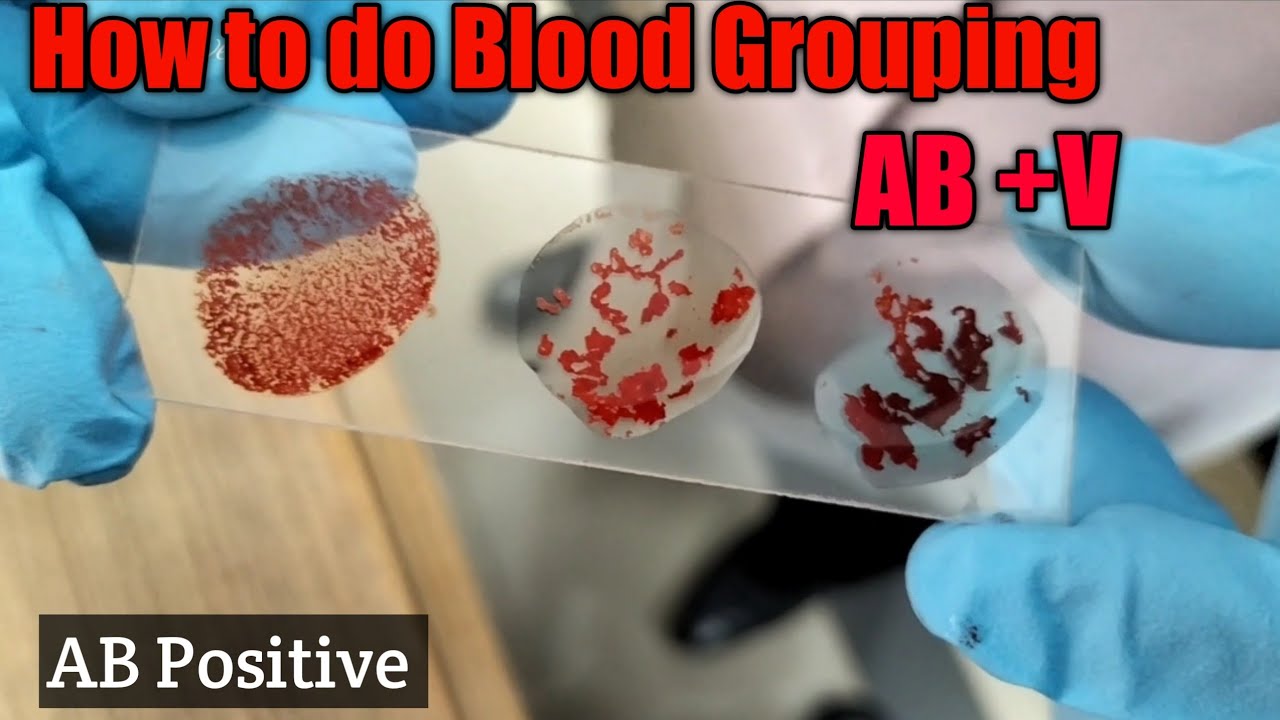 How to do Blood Grouping ll AB +V ll Blood Group ll AB Positive ll ...