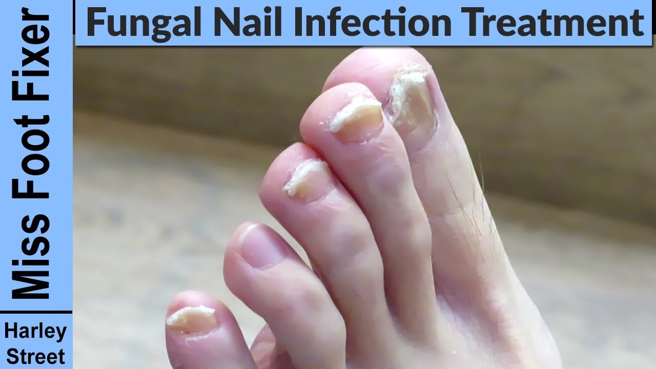 How to clear fungal nail, how to get rid of fungal nail infection Miss ...