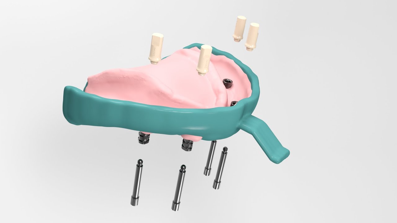 DAS MU SCANALOG DIRECT TO IMPLANT - YouTube