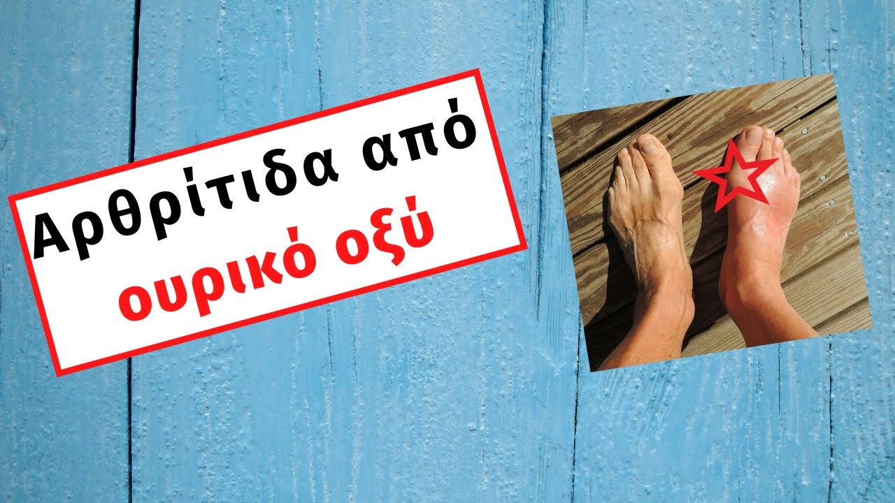 Αρθρίτιδα από ουρικό οξύ - YouTube