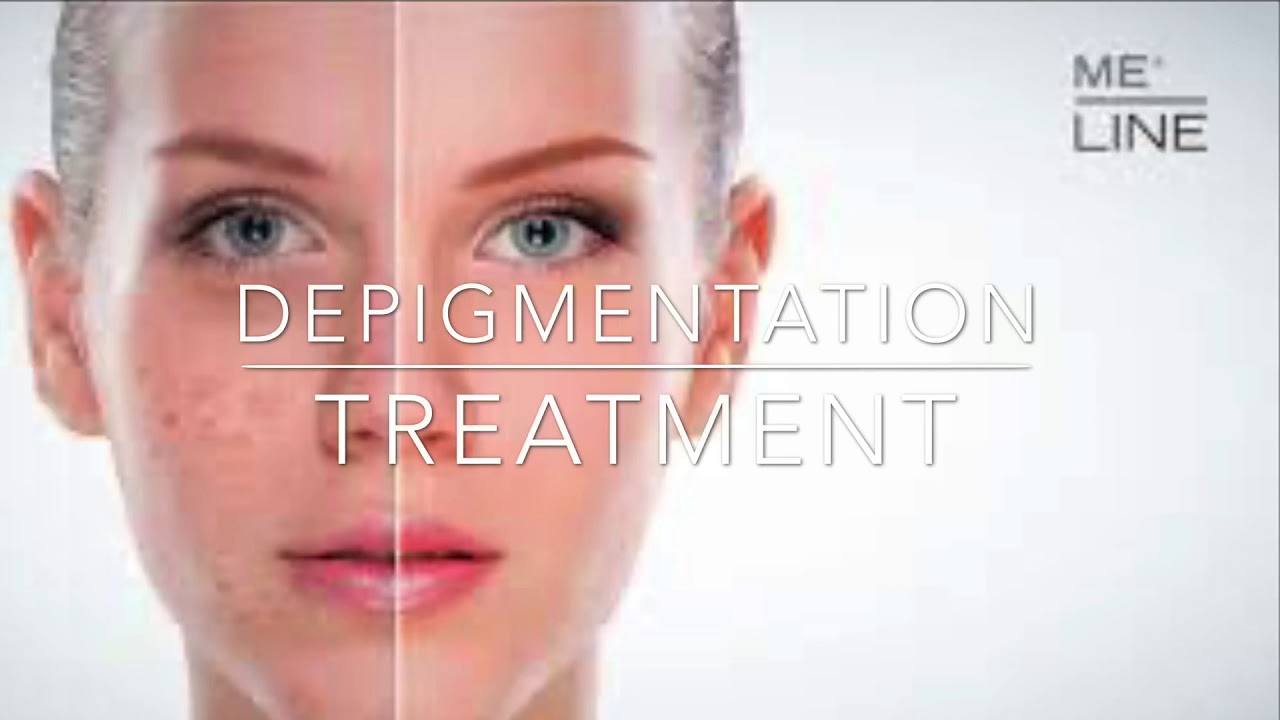 Meline Depigmentation Treatments - YouTube