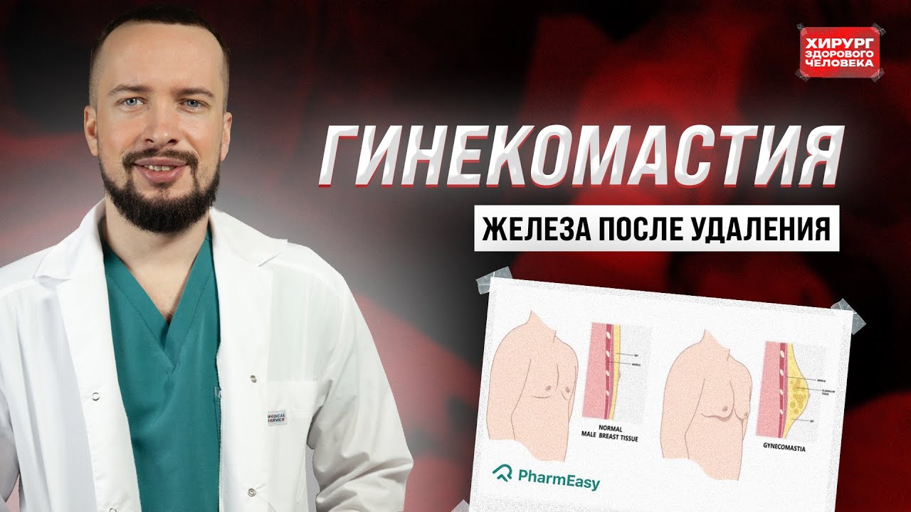 Гинекомастия Как выглядит железа после удаления Youtube