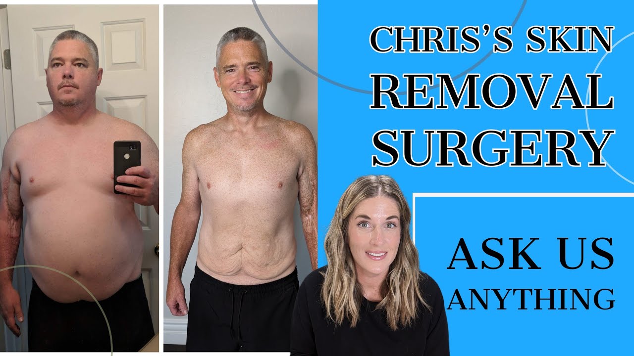 Laura And Chris Livestream Before Chriss Skin Removal Surgery Ask Us Anything Youtube
