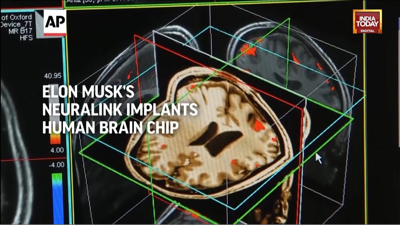 Elon Musk says the first human has received an implant from Neuralink ...