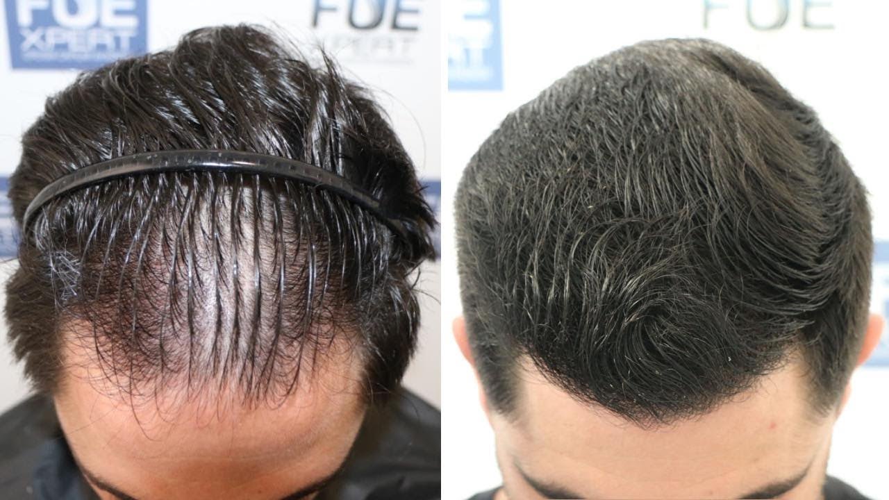 FUE Hair Transplant (2200 Grafts - NW Class III-A) By Dr Juan Couto ...