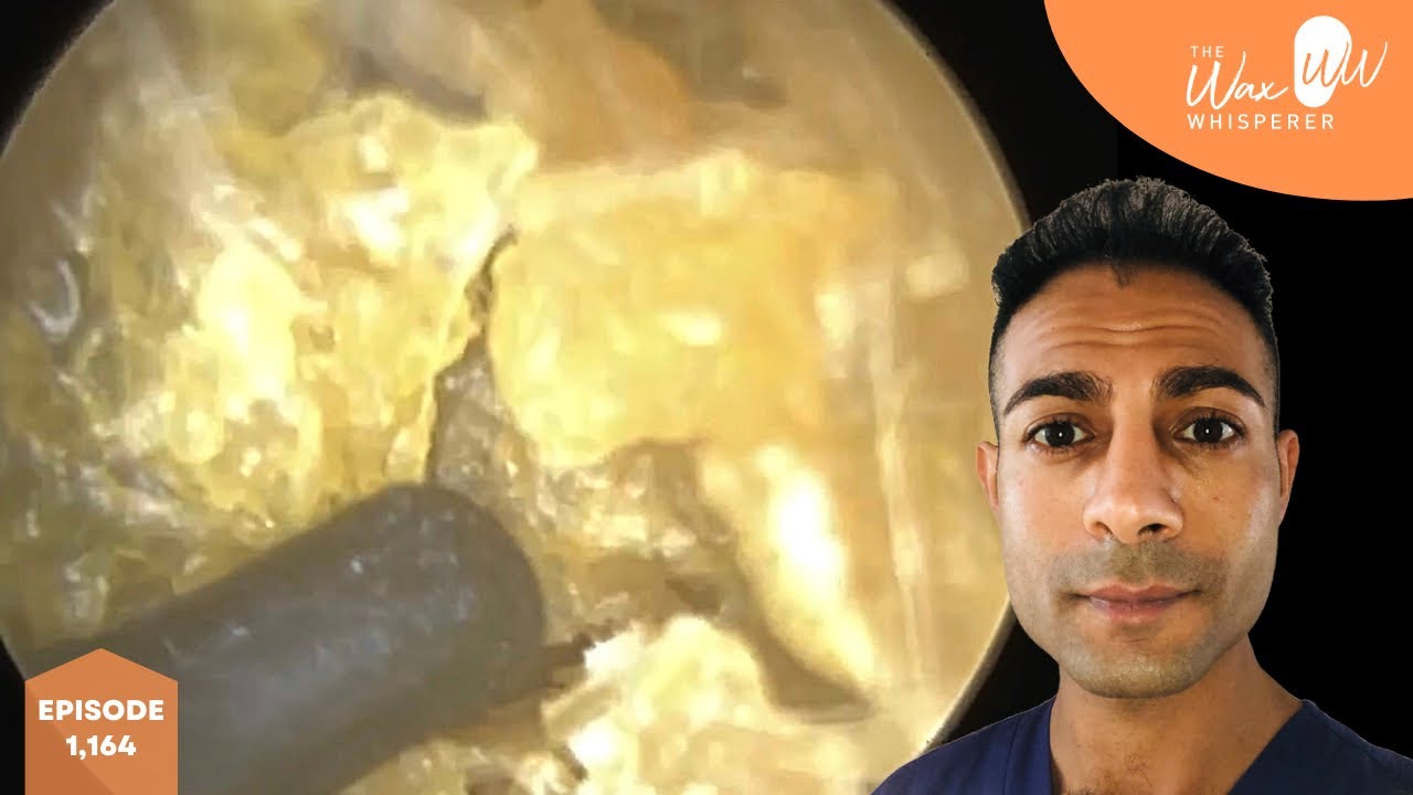 1,164 - Complete Dead Skin Peel & Extraction from Childs Ear - YouTube