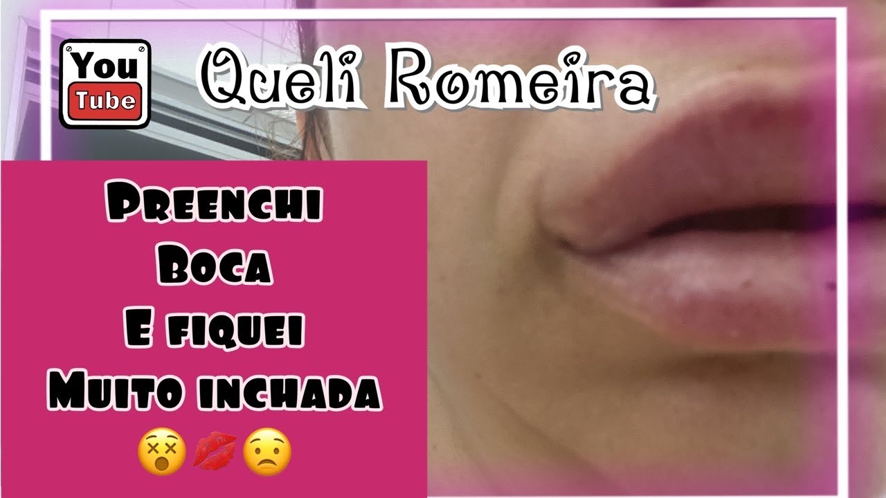 Fiquei Com Um BocÃo Após O Preenchimento Labial Dor Inchaço