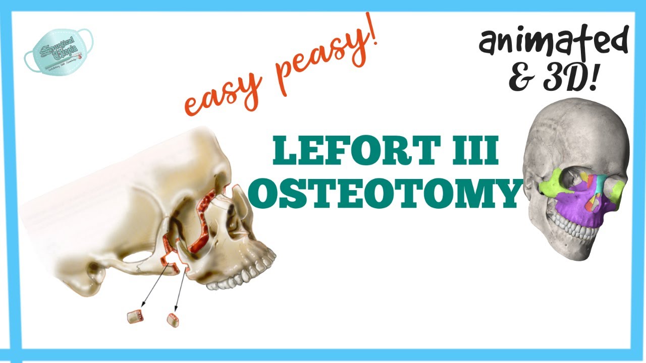 LEFORT III OSTEOTOMY || MAXILLARY OSTEOTOMY - YouTube