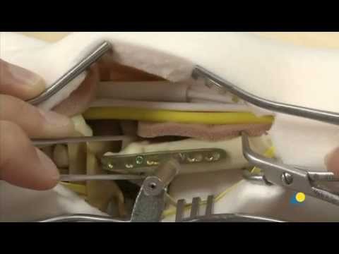 AO distal ulna hook plate - YouTube