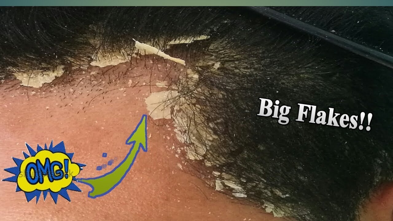 Return of Big Flakes Dandruff Satisfying Flaky Scalp #235. - YouTube