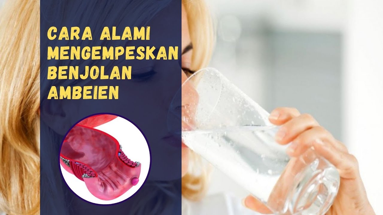 Cara Alami Mengempeskan Benjolan Ambeien - YouTube