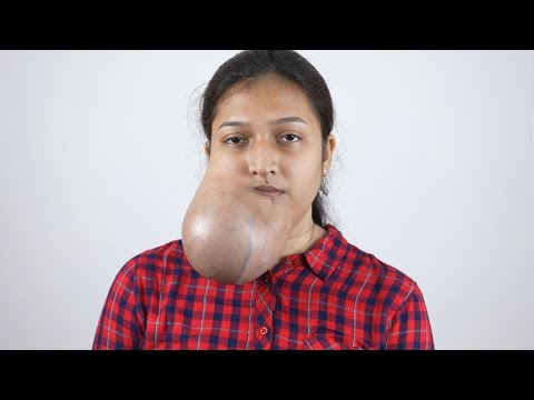 Giant Facial Tumor on Face Pre Surgery Complete Consultation