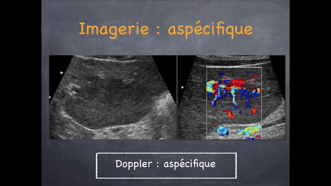 Tumeurs du foie - Bénignes - 5. Adénome - YouTube