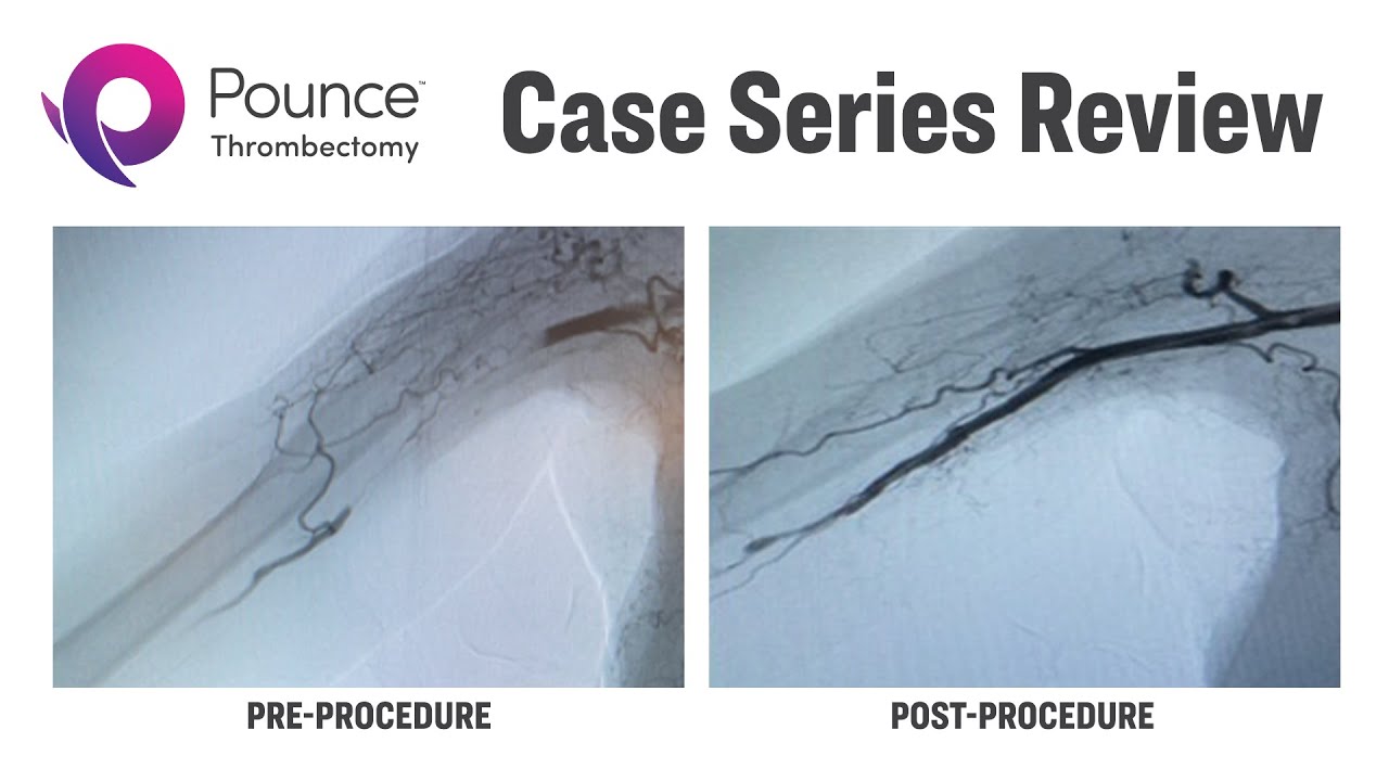 Brachial Embolus Removal with the Pounce™ Thrombectomy System - YouTube