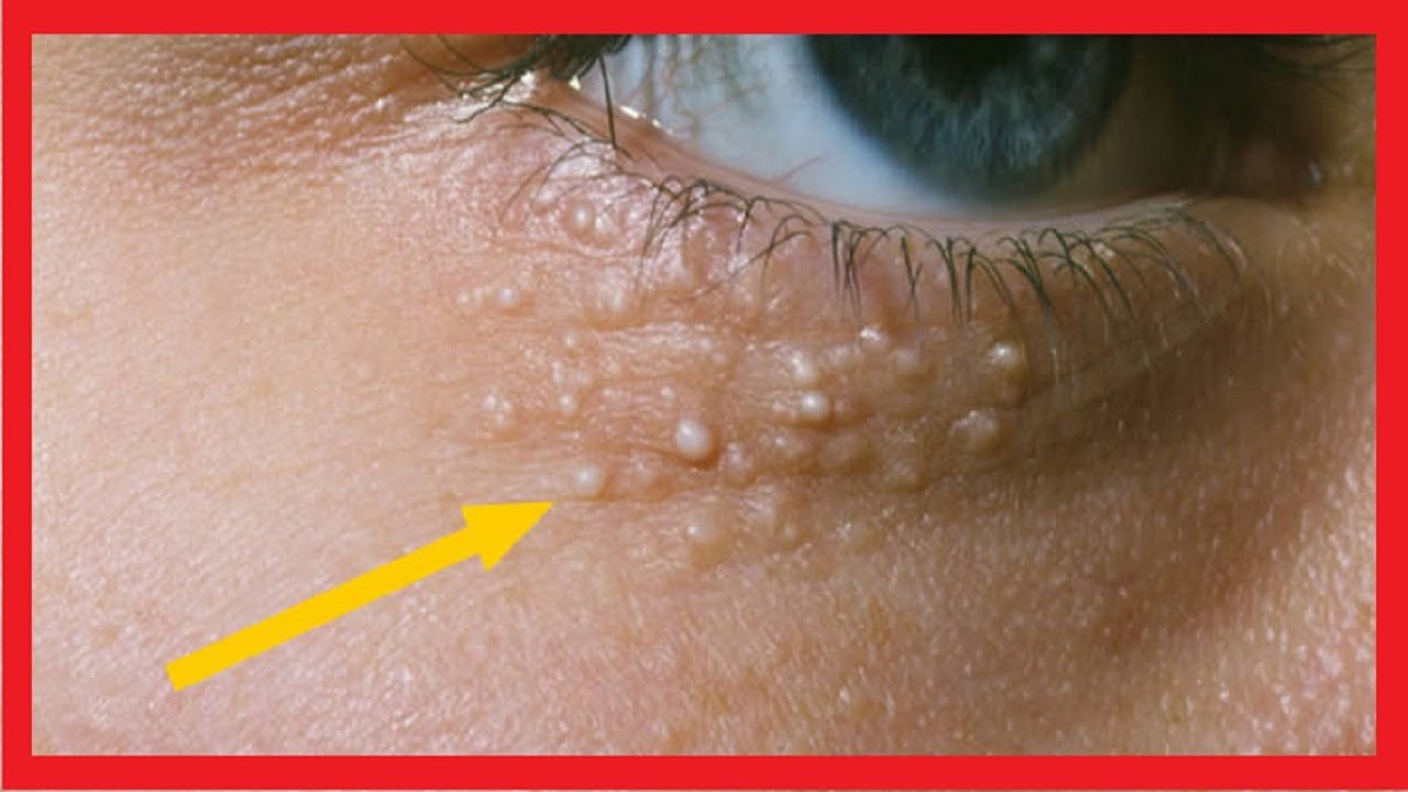 Cum să scapi de bulele albe enervante de pe piele - YouTube