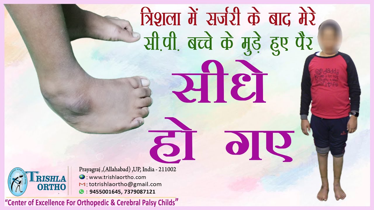 Ponseti Plaster: An Effective Solution for Recurrent Clubfoot (CTEV ...