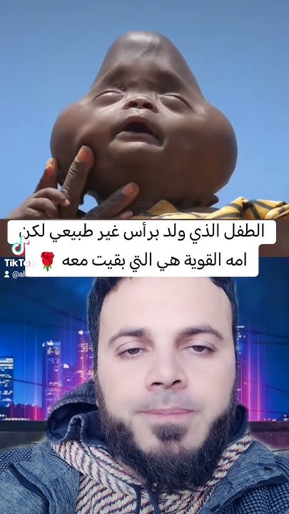 طفل ولد برأس غير طبيعي لكن امه لم تتركه #ماهر_ابو_يزن - YouTube
