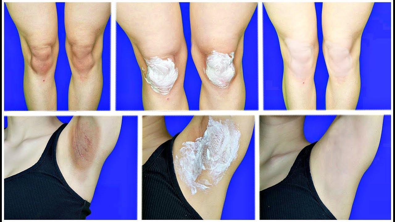 How To Lighten Your Dark Body Parts, Dark Knees, Elbows & Underarms ...