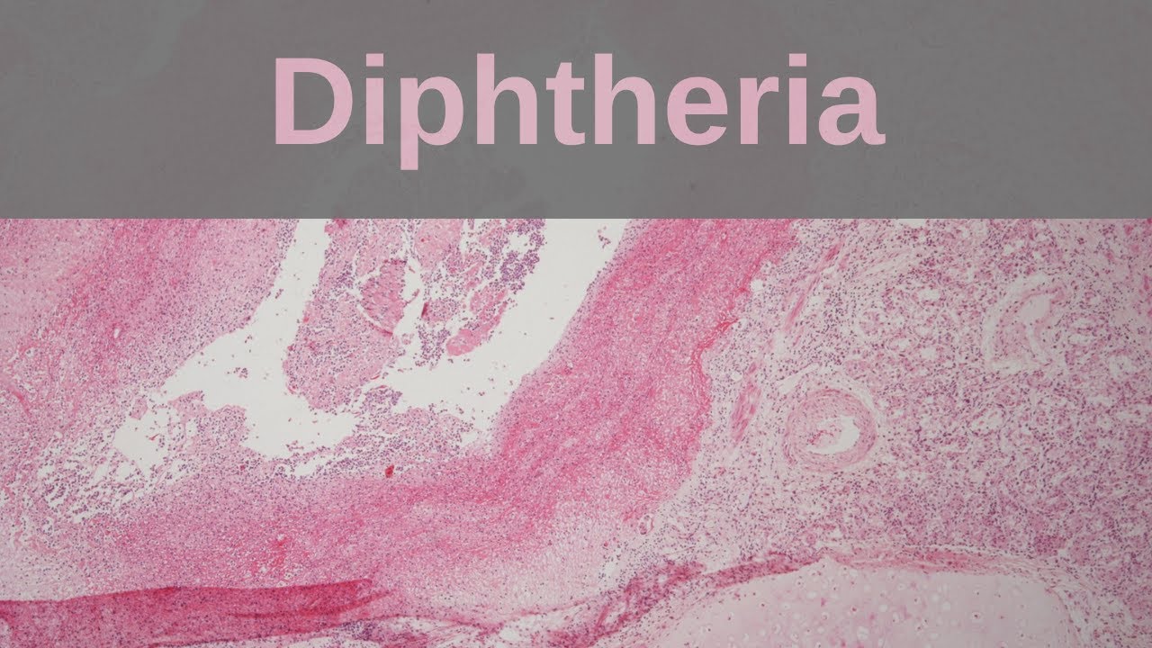 Diphtheria - Pathology mini tutorial - YouTube