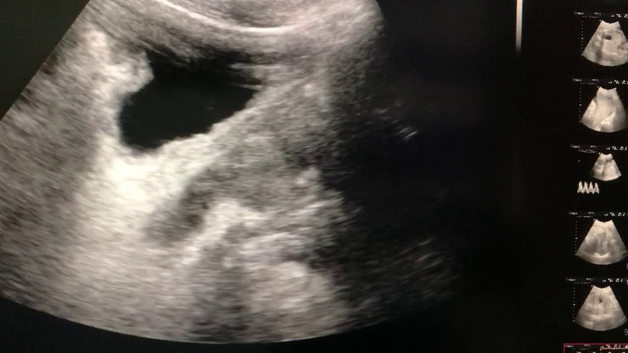 Prostatic calcification ultrasound - YouTube