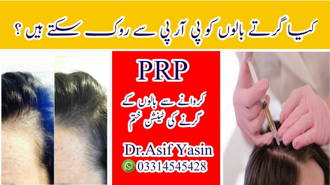 Prp Hair Treatment Hair Loss Rokne Ka Tarika Prp Results Prp Therapy