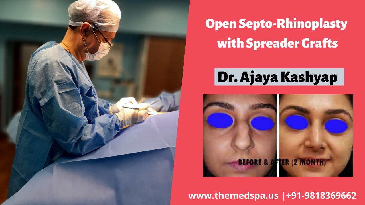 Open Septo-Rhinoplasty Surgery by Dr. Ajaya Kashyap, Delhi, India - YouTube