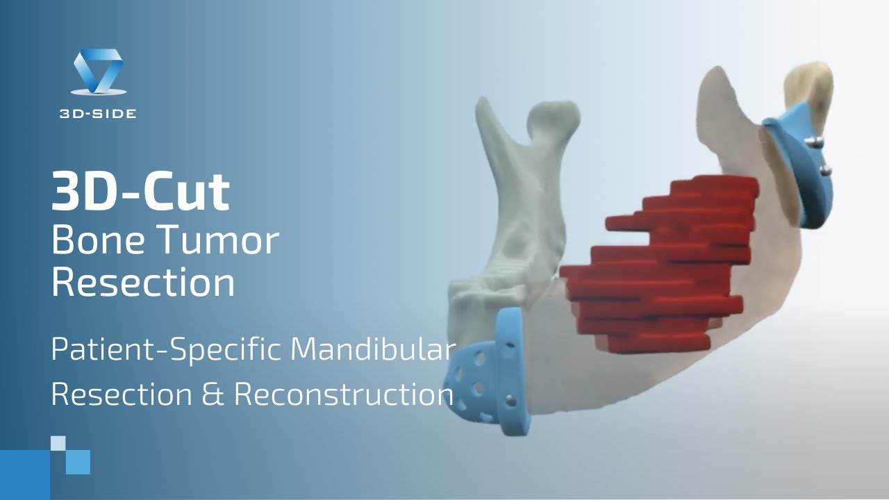 3D-Cut - Patient-Specific Mandibular Resection and Reconstruction - YouTube