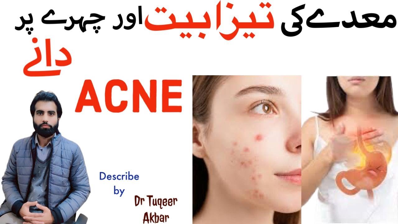 Acne| Acidity & Acne| Pimples | Black heads | White heads | Face Fresh ...